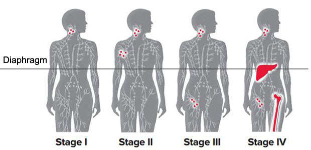 Lymphoma Staging | St. Stamford Modern Cancer Hospital Guangzhou